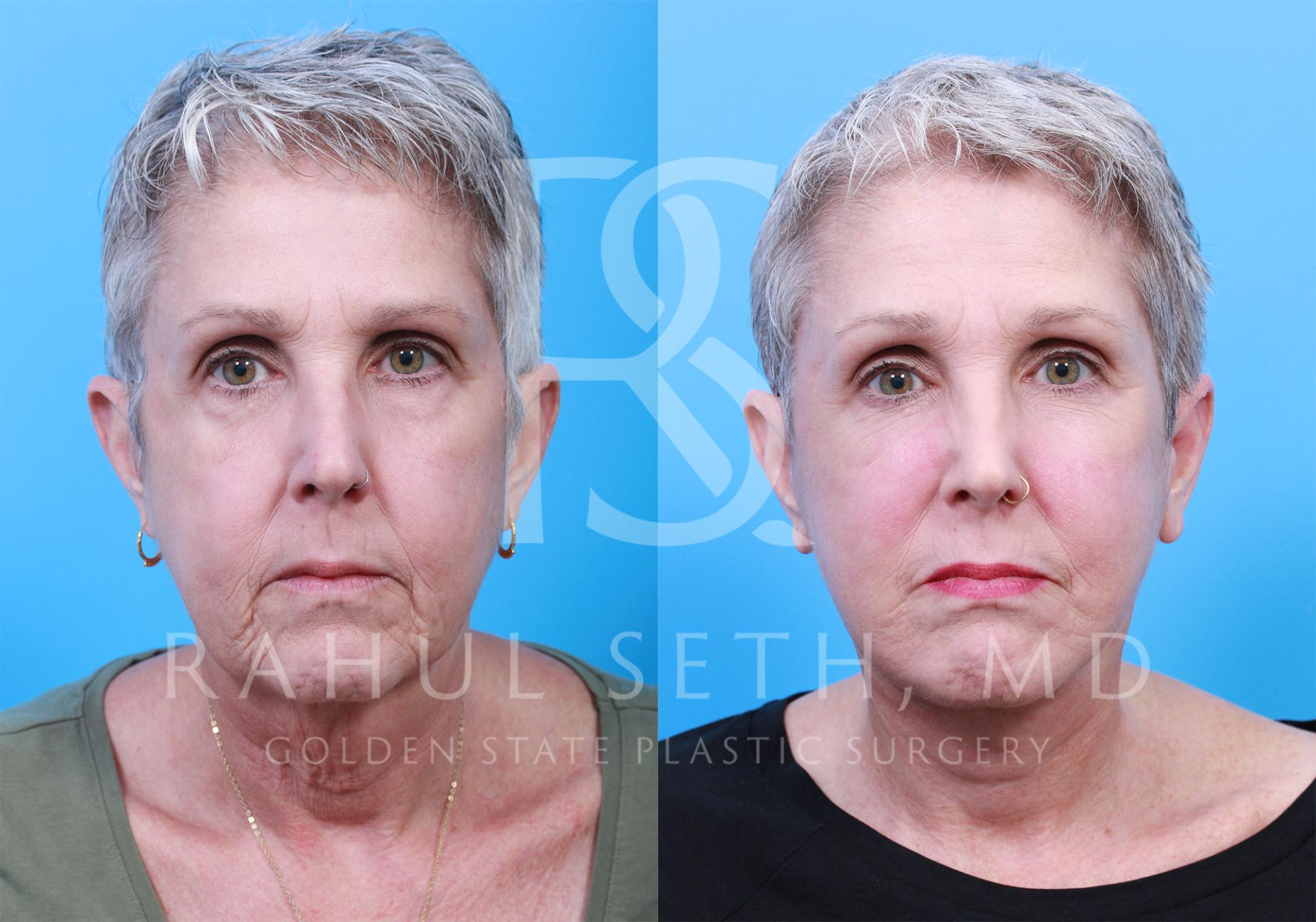 Plastic Surgery San Francisco | Walnut Creek | Golden State Plastic Surgery