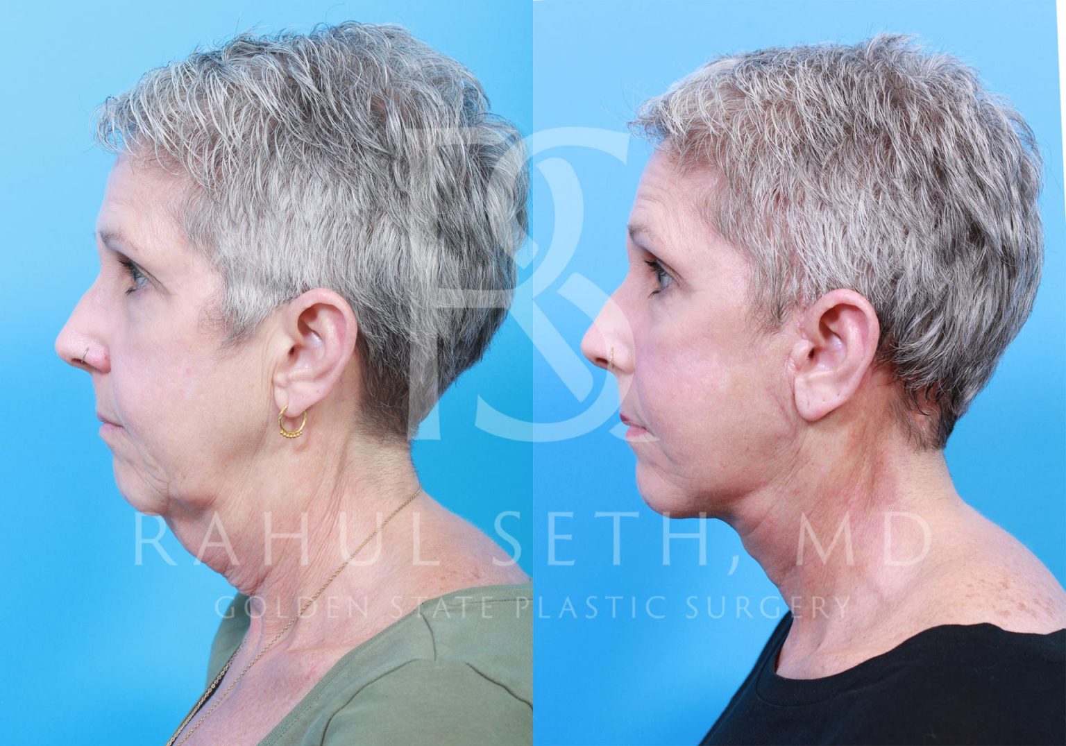 Plastic Surgery San Francisco | Walnut Creek | Golden State Plastic Surgery