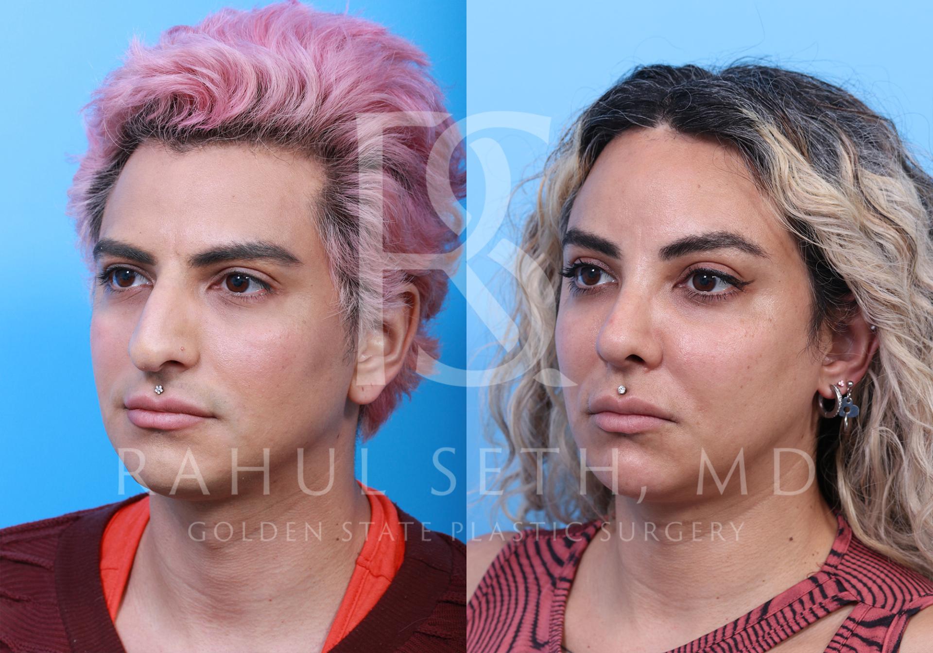 FFS San Francisco | Golden State Plastic Surgery