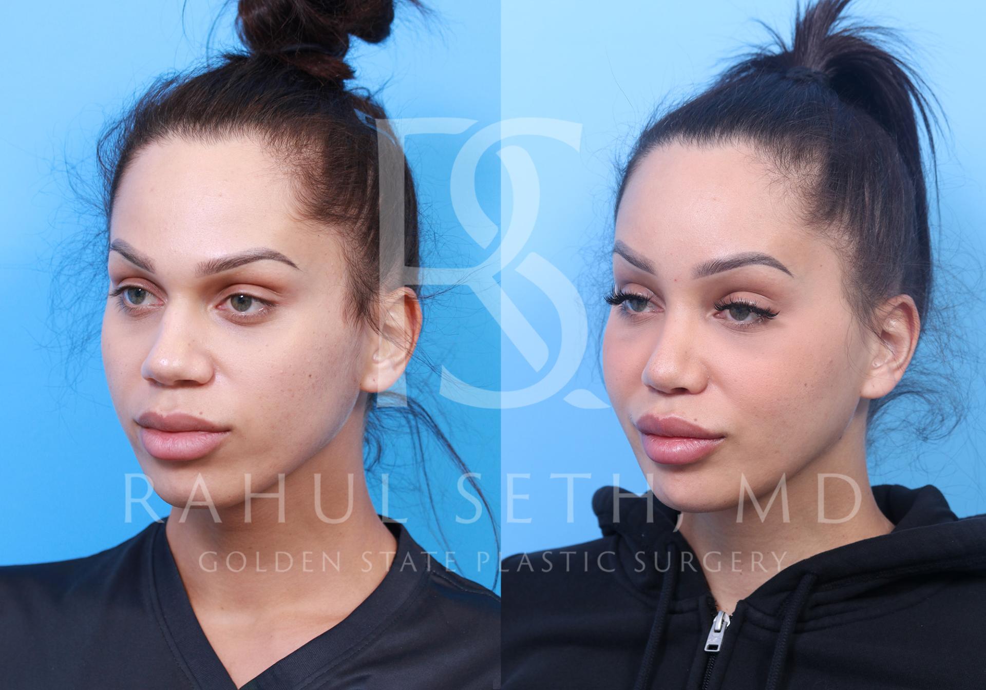 Plastic Surgery San Francisco | Walnut Creek | Golden State Plastic Surgery