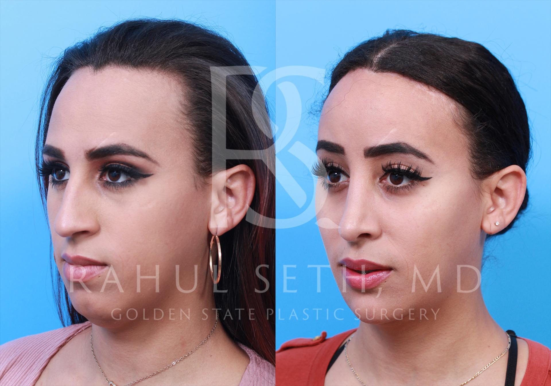 FFS San Francisco | Golden State Plastic Surgery